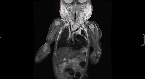 Magnetic Resonance Imaging Short T1 Inversion Recovery Stir Sequence