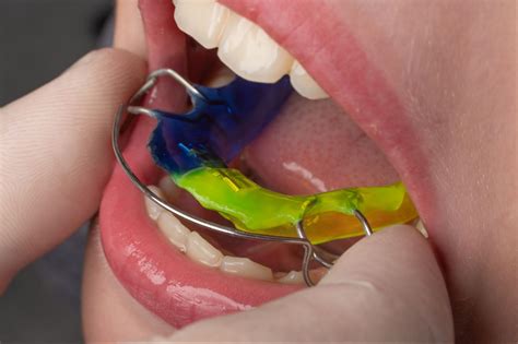 Why Choose Fixed Retainers Ollins Orthodontics