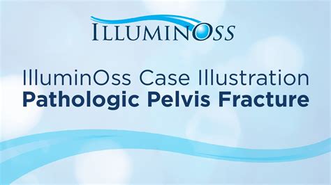 Case Illustration Pathologic Pelvis Fracture
