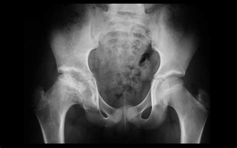 Avascular Necrosis AVN Right Femoral Head Epiphysis Hip XR 2 2 Flickr Photo Sharing