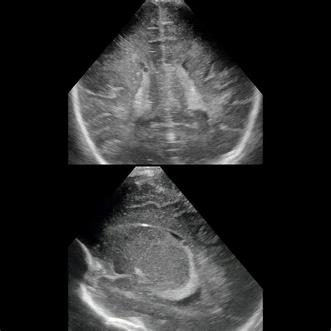 Pediatric Choroid Plexus Cyst Pediatric Radiology Reference Article