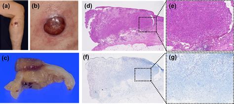 Pseudotumor Of The Skin Due To Mycobacterium Genavense International Journal Of Infectious
