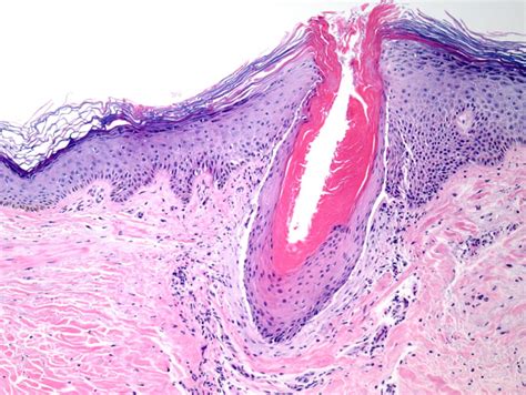 Follicular Hyperkeratosis Scalp