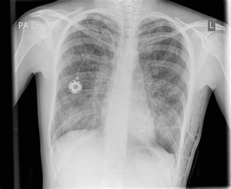 Can A Chest X Ray Show Cystic Fibrosis At Carmen Holbrook Blog