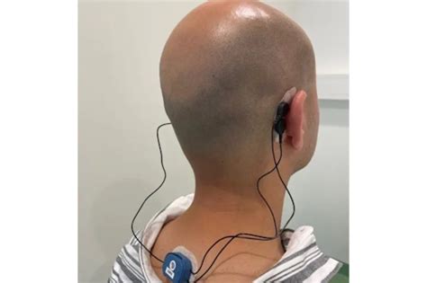 Una Europa Epilepsy Data Challenge Una Europa