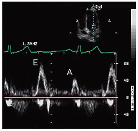 Diastolic Function Flashcards Quizlet