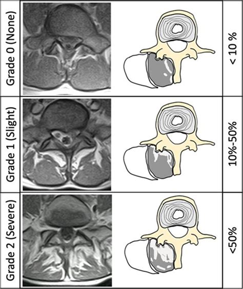 Multifidus Muscle Mri