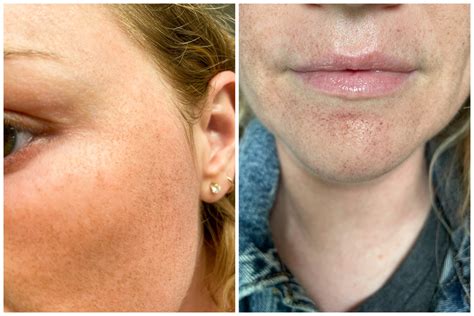 Extra Lsr Skin Resurfacing With Moxi Laser Le Stylo Rouge