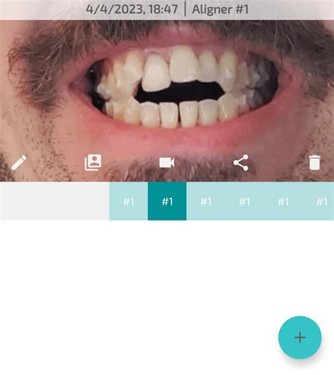 1 Year Progress Open Bite Rinvisalign
