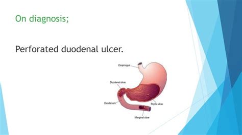 Case Presentation On Perforated Duodenal Ulcer Pptx