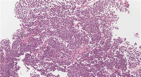 Ewings Sarcoma Ottawa Atlas Of Pathology