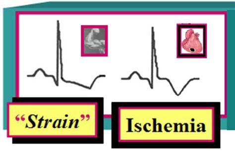 ECG Interpretation ECG Blog TWI Juvenile T Wave Variant