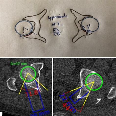 Measuring Acetabular Fracture Index Afi In Calkins Et Al Method 11 Download Scientific