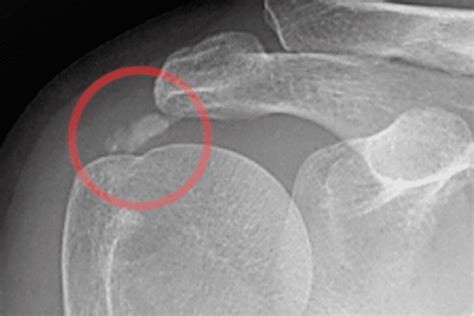 Calcific Tendonitis Cyprus Orthopaedics