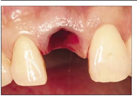 Figure 6 Extraction Defect Assessment Classification And