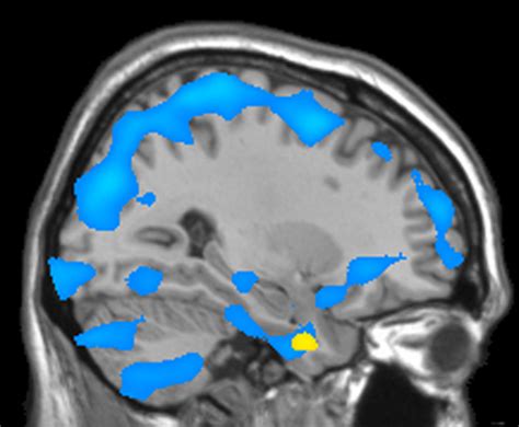 Deric S Mindblog Sexual Orientation In Women Brain Correlates