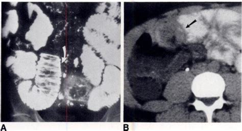 Target Pattern Of Enteroenteric Intussusception In 23 Year Old Man
