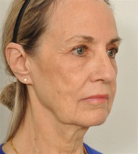 Forehead Lipoma Excision In New York City Dr Benjamin Paul