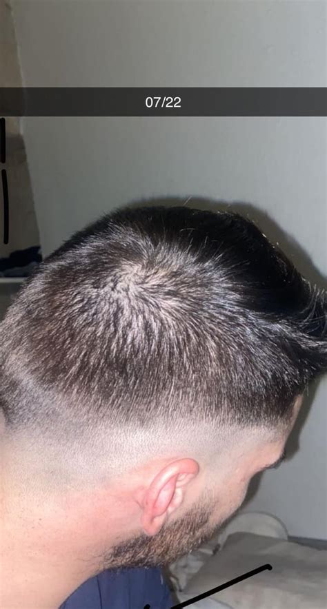 Worsening Of Diffuse Alopecia Despite Treatment Dutas 0 5 5mg Minox 1x