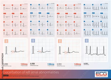 In 2004 A 51 Year Old Woman Was Diagnosed With Mitral Stenosis And
