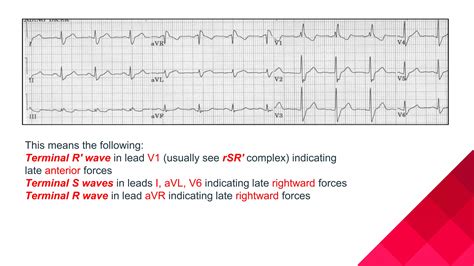 Ecg Conduction Abnormalities Pptx