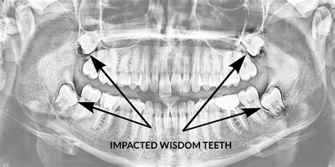 Wisdom Teeth Dr Regina Saenz Dds Pa Oral Maxillofacial Surgeon