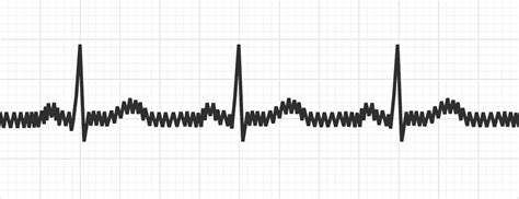 Quality Of The Ecg Trace Ecg Basics Medschool