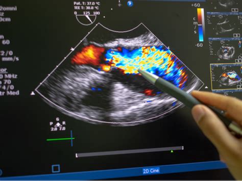 Your Complete Guide To Echocardiograms Portable Ultrasound Machine