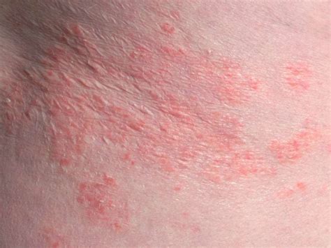 Smelly Rash In Groin Area Male Ujwbb