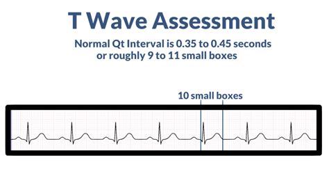 Interpreting Ecg Strips Nursing Unraveled
