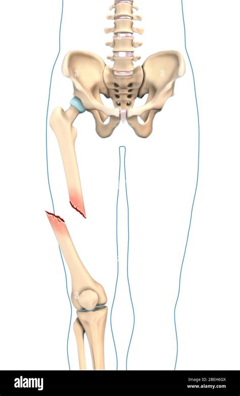 Compound Fracture Diagram