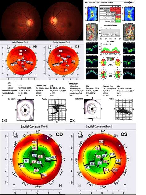Case 1 A Fundus Photography Showing Myopic Tilted Disc In Both Eyes Download Scientific