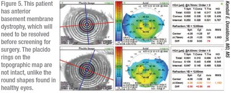 Hone Your Refractive Screening Process
