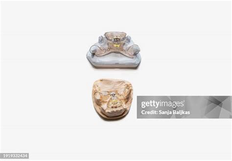 Amalgam Dental Fillings Photos And Premium High Res Pictures Getty Images