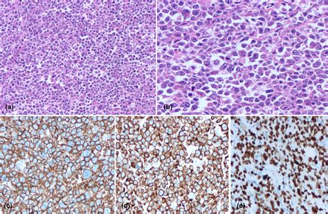 Immunohistochemistry Of The Needle Biopsy From The Breast Hematoxylin Download Scientific