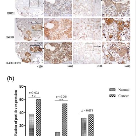 A Ihc Analysis Of Protein Expression In Cancer Tissues And Adjacent