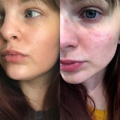 342 Best Differin Images On Pholder Skincare Addiction Acne And Tretinoin