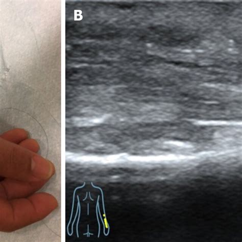 Three months after resection of traumatic neuroma. A: Appearance; B ...
