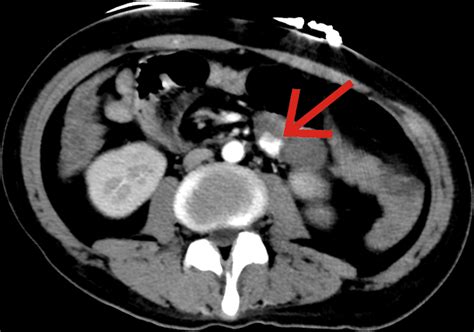 Massive Digestive Tract Bleeding Caused By Ebv Triggered Hemophagocytic Lymphohistiocytosis And