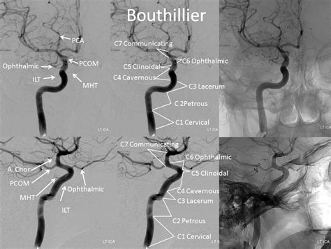 Internal Carotid Artery And Its Aneurysms Internal