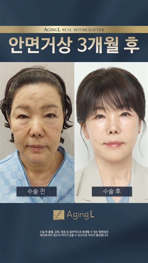 에이징엘 안티에이징 성형외과 안면거상 목거상으로 10년 젊어지기수술 3개월 경과 안면거상과 목거상 하안검을 함께