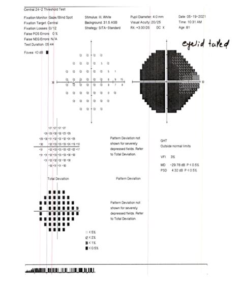 navigating visual field loss visual neglect and ocular dominance a