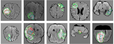 Slices Of Images From The Brain Tumour Dataset Green Edema Red