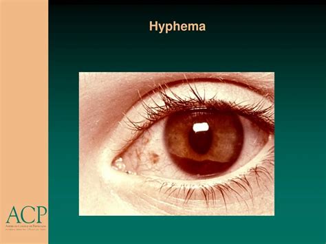 Ppt Quick Guide To Corneal Conditions Symptoms Treatment And