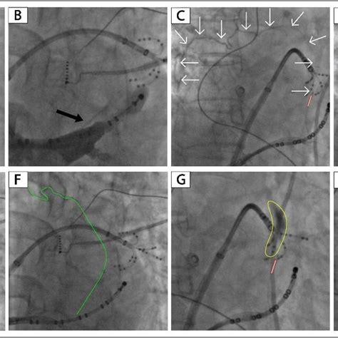 Successful Ethanol Infusion In A Vom With Collateral Circulation To The Download Scientific