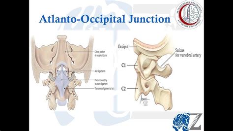 Atlanto Occipital Dislocation