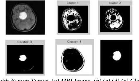Figure 2 From Brain Tumor Detection And Segmentation Using Css