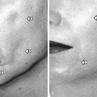 A 45 Year Old Woman With Depressions Of The Left Malar Eminence A And