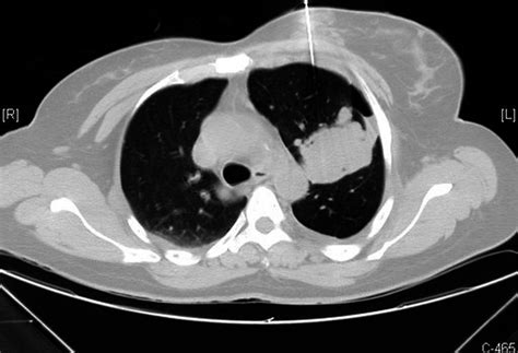 What Does Lung Cancer Look Like In A Ct Scan Ct Scan Machine