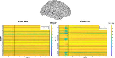 Stereotactic Eeg Electrodes Implantation Of One Subject Having One